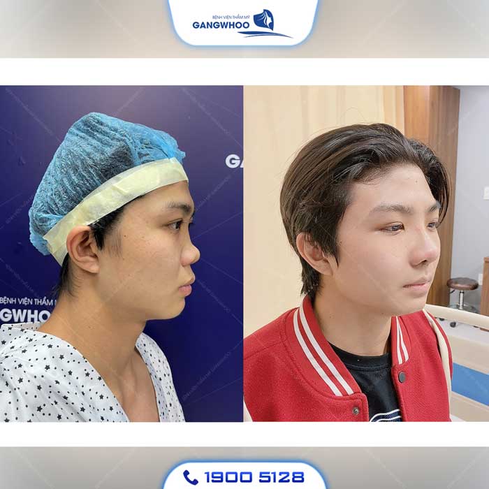 8 Types of Ugly Nose Shapes That Can Be Corrected!! Standards for ...