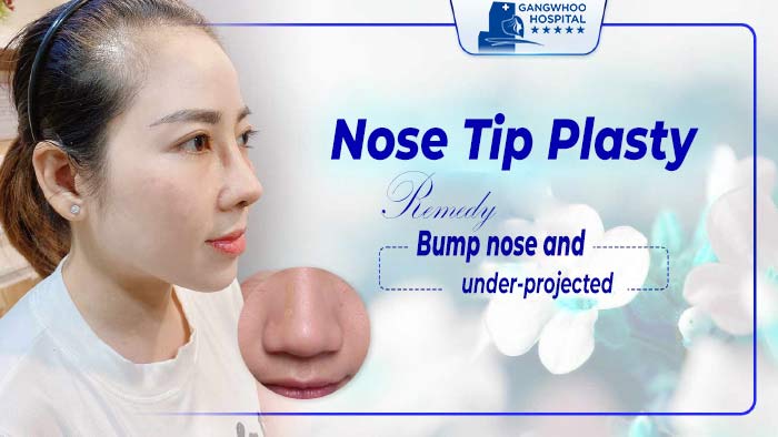 Nose Tip Plasty - Improve Large and Rough Nose Tip