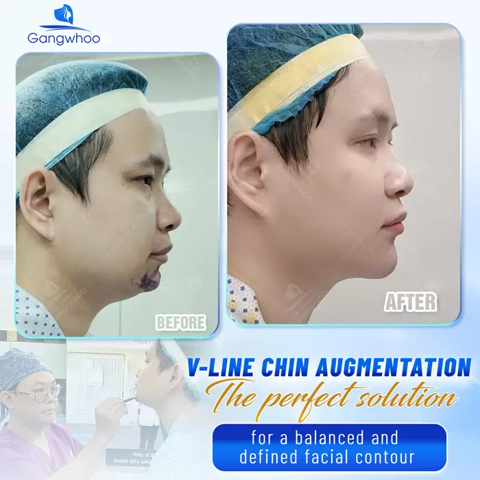 What Is Endoscopic V-Line Chin Augmentation with Microsurgery ...