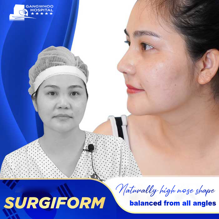 Surgiform Rhinoplasty - The Best Solution For A Luxurious Nose