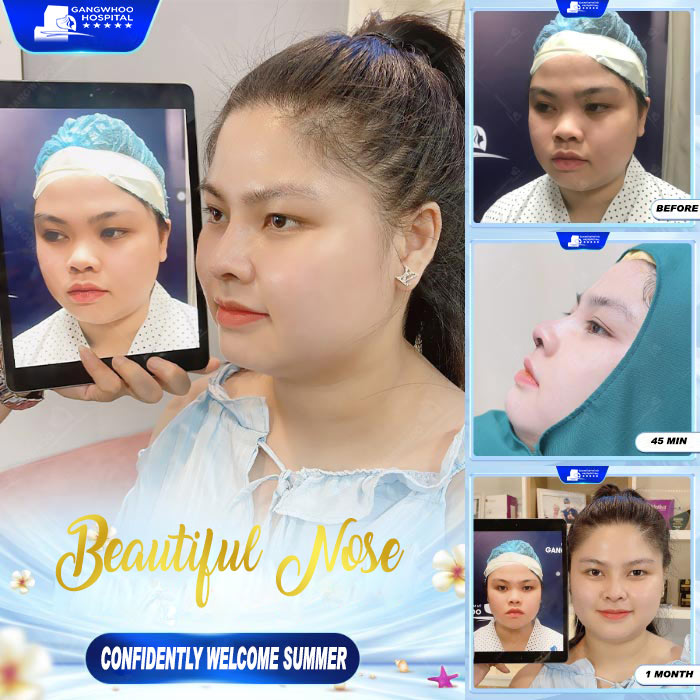 Surgiform Rhinoplasty - The Best Solution For A Luxurious Nose