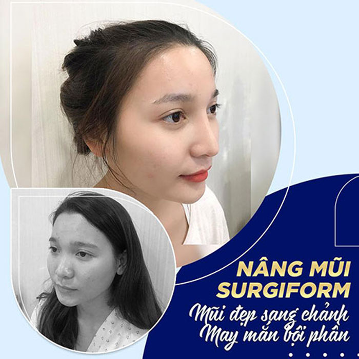 Surgiform Rhinoplasty - The Best Solution For A Luxurious Nose