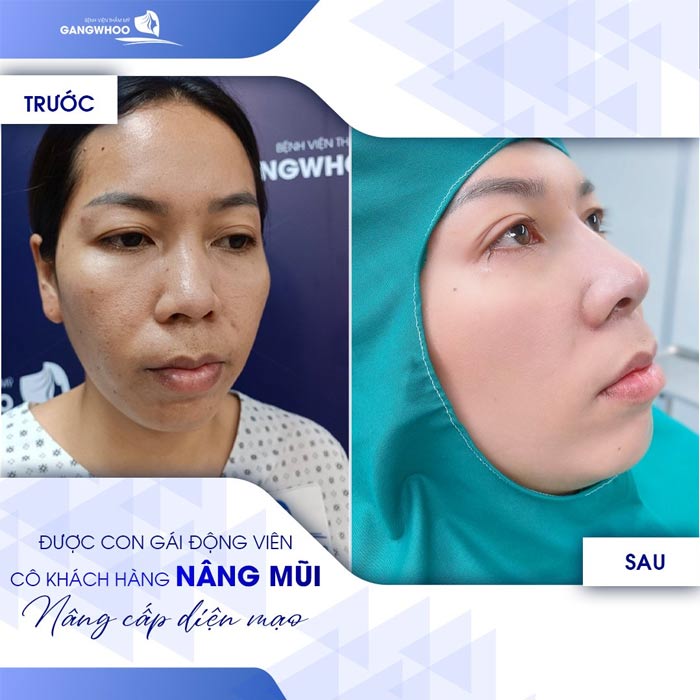 Sự Thật Về Nâng Mũi Sụn Sinh Học Hàn Quốc